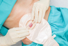 Colostomia Definitiva: Entendendo o Procedimento e Seus Impactos ...